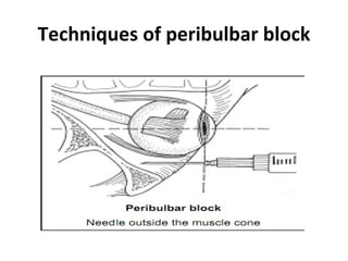 Peribulbar Injection