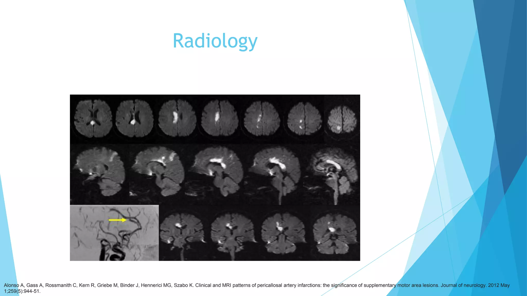Pericallosal Artery Infarction & Alien Hand Syndrome | PPTX