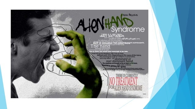 Pericallosal Artery Infarction & Alien Hand Syndrome | PPT