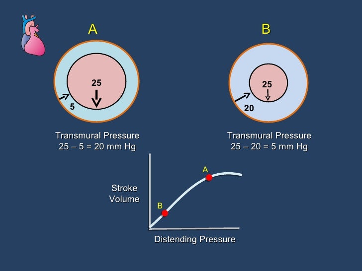 Pericardial Dse Cath Lab