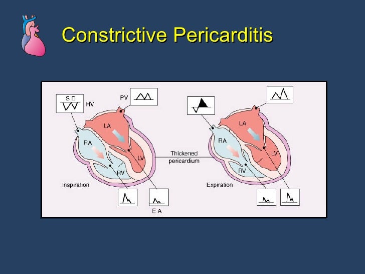 Pericardial Dse Cath Lab