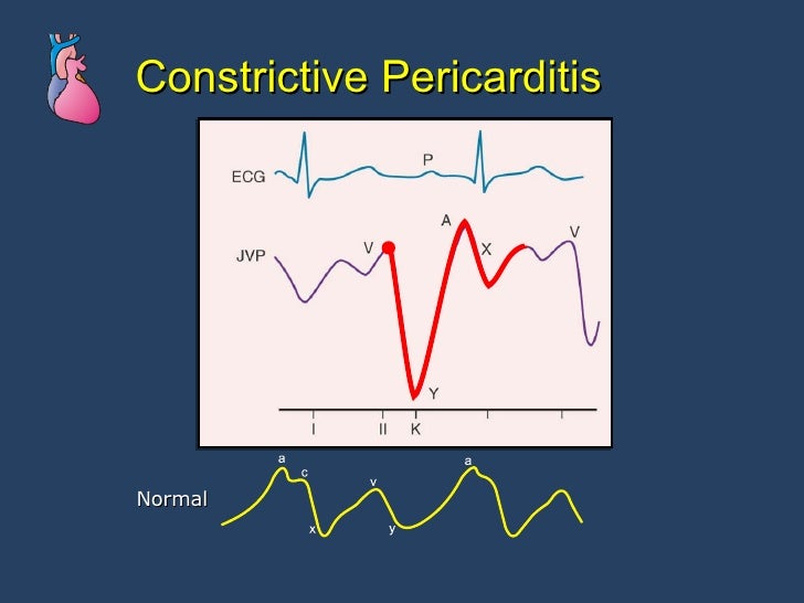Pericardial Dse Cath Lab