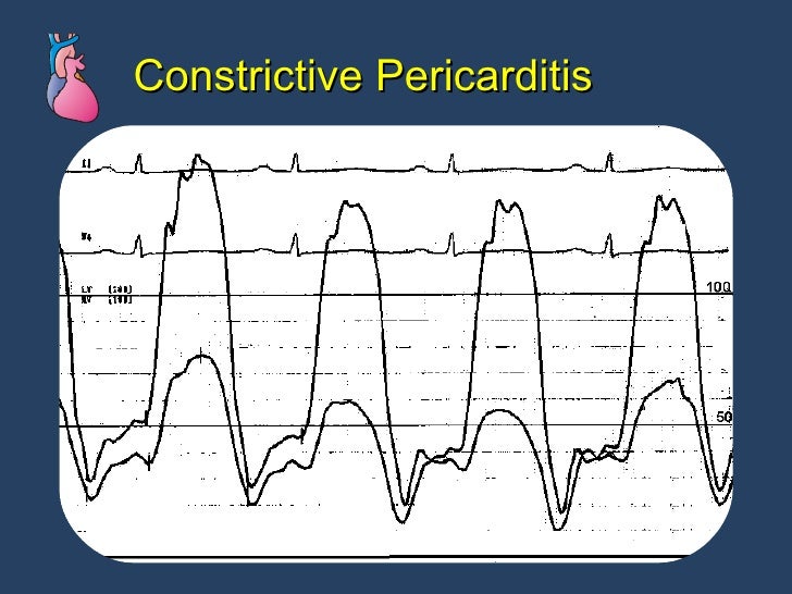 Pericardial Dse Cath Lab