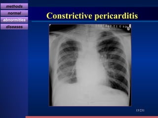 Constrictive Pericarditis Xray
