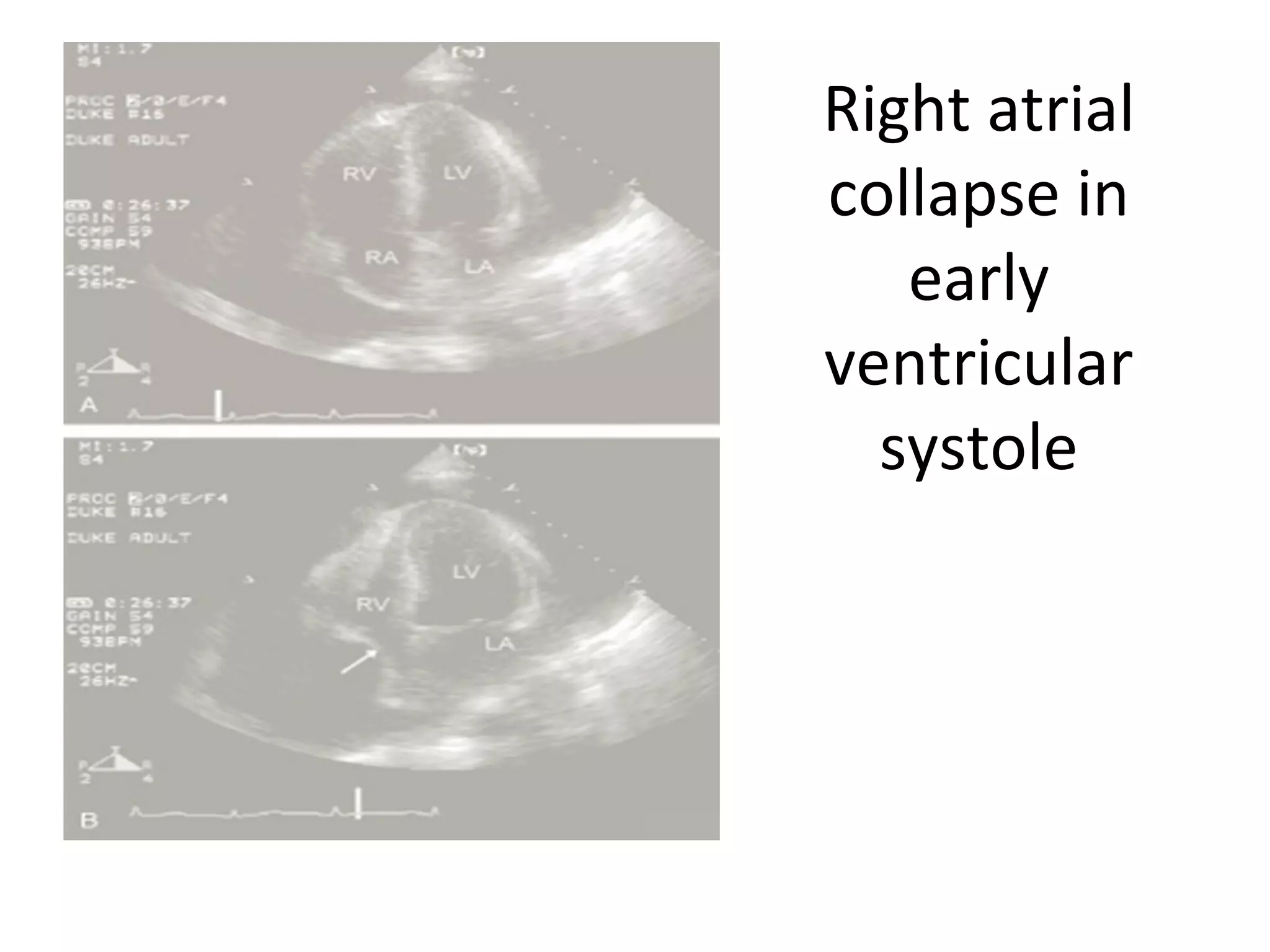 Pericardial compressive syndromes | PPT