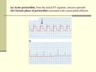 PERICARDIAL DISEASE CLI 401 for medical students.ppt