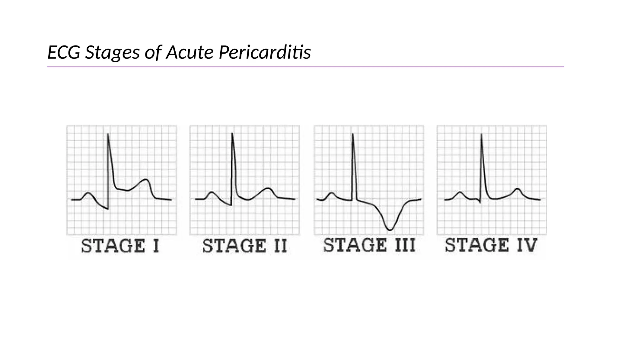 Pericardial disease esc guidlines pptmon.pptx