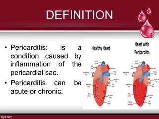 Pericardial diseases part i | PPT