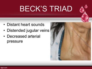 Pericardial diseases part ii | PPT