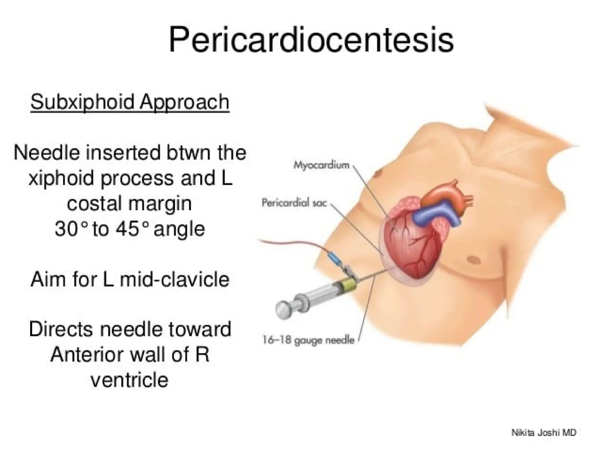 pericardial effusion-1.pptx . | PPTX