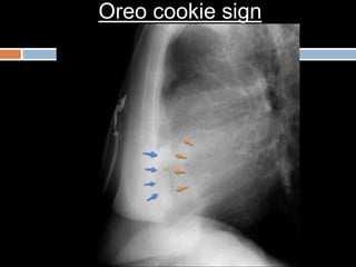 Imaging of Pericardial effusion | PPTX