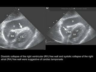 Imaging of Pericardial effusion | PPTX