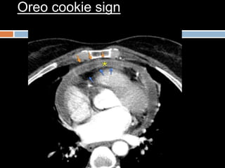 Imaging of Pericardial effusion | PPTX