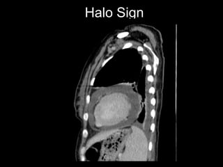 Imaging of Pericardial effusion | PPTX
