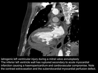 Imaging of Pericardial effusion | PPTX