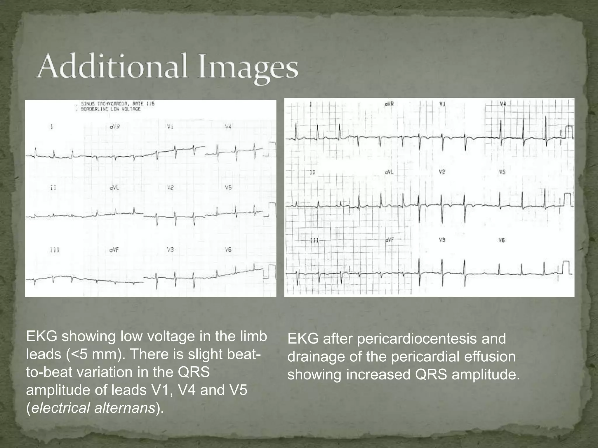 Pericardial effusion | PPTX