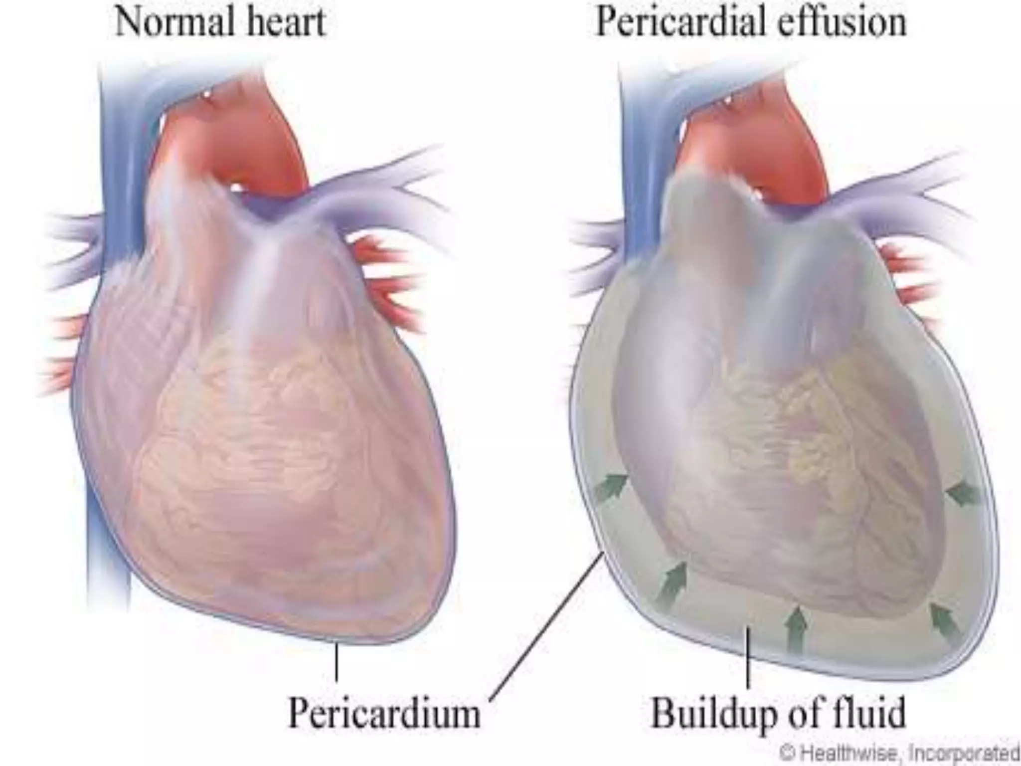 Pericardial effusion | PPTX