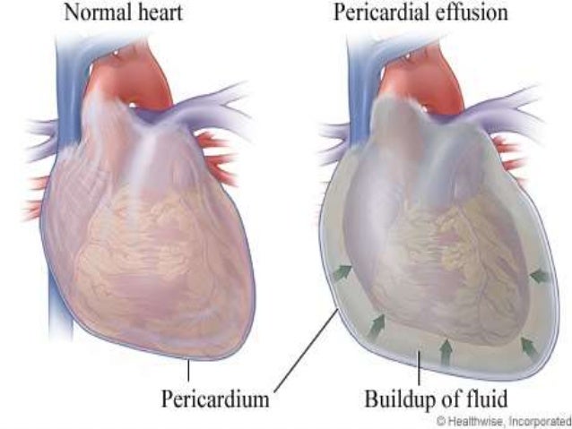 Pericardial effusion