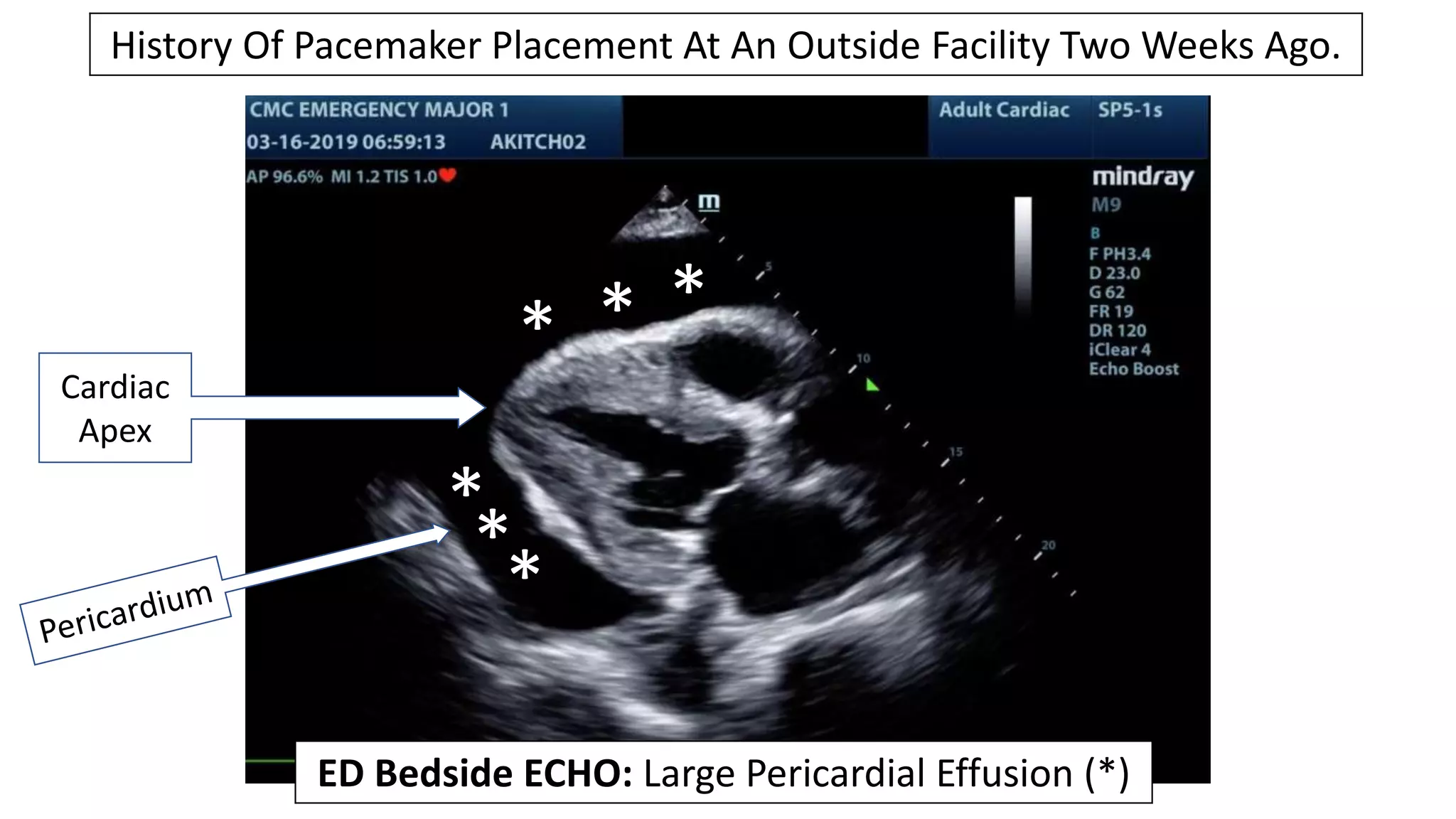 EMGuideWire's Radiology Reading Room: Pericardial Effusion | PPTX