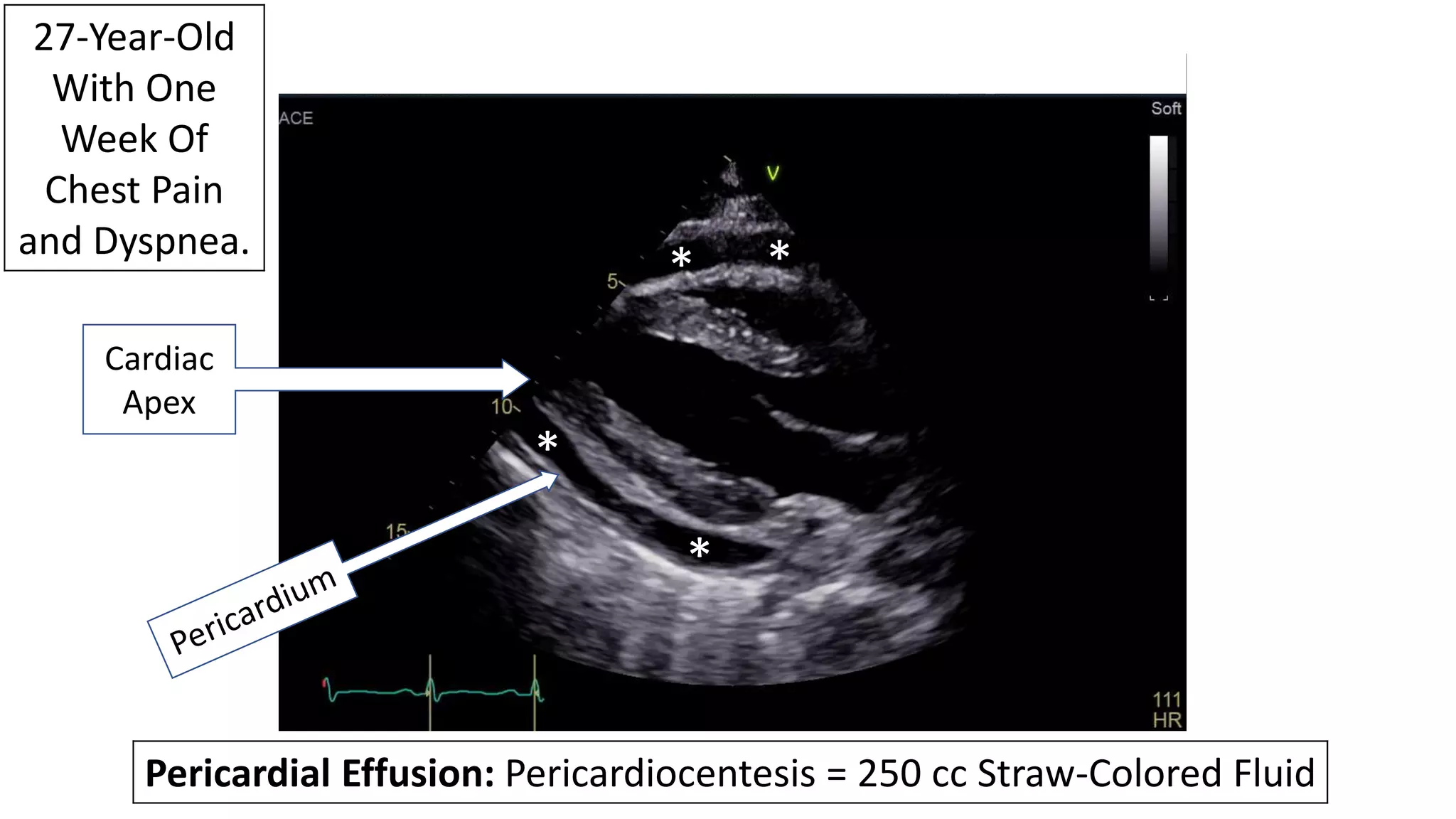 EMGuideWire's Radiology Reading Room: Pericardial Effusion | PPTX