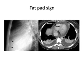 Pericardial tamponade | PPTX