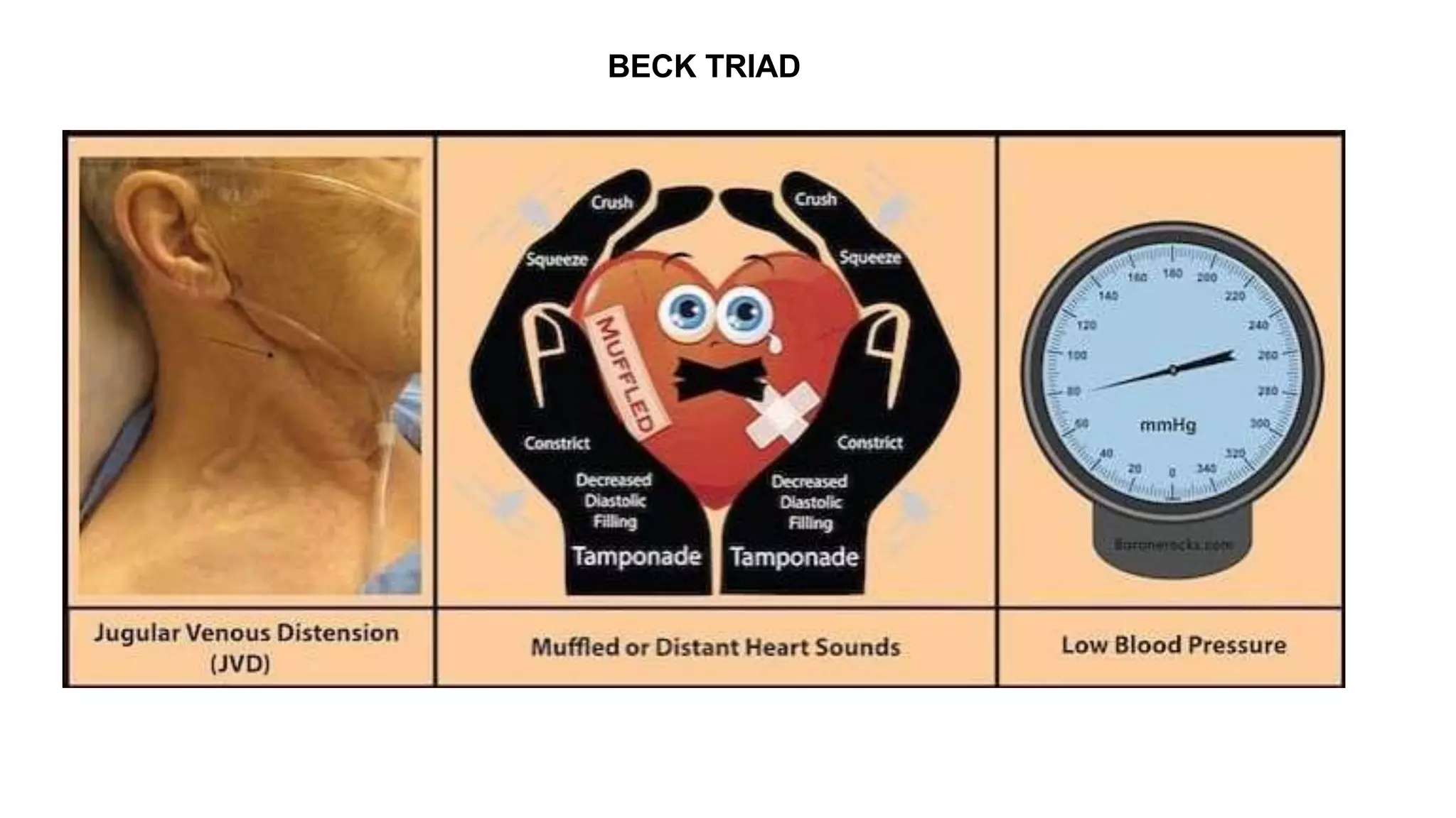 Pericardial tamponade | PPTX