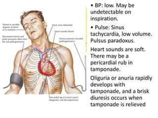 Pericardial Tamponade | PPTX