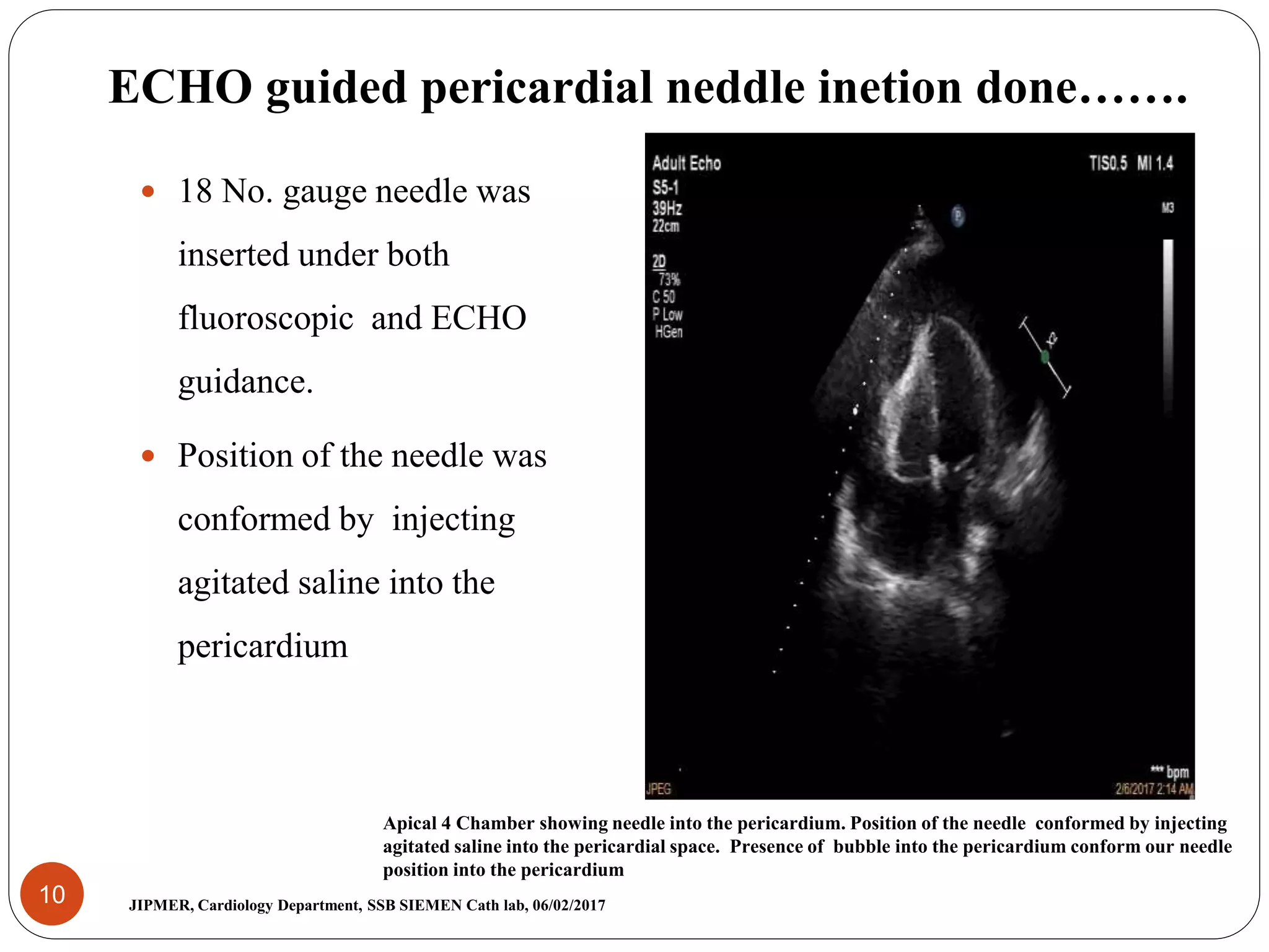 Pericardiocentesis | PPTX