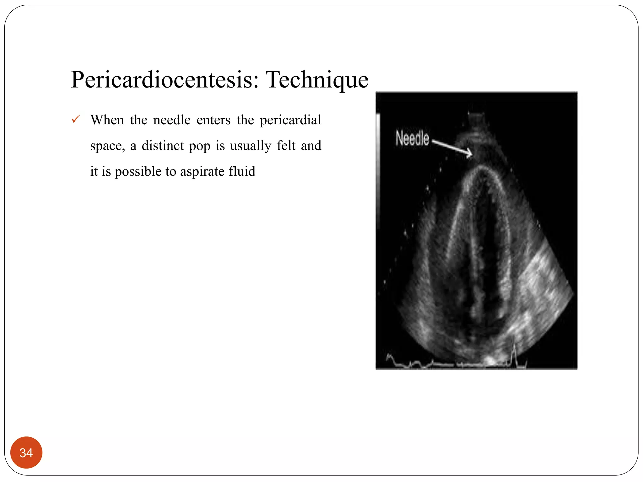 Pericardiocentesis | PPTX