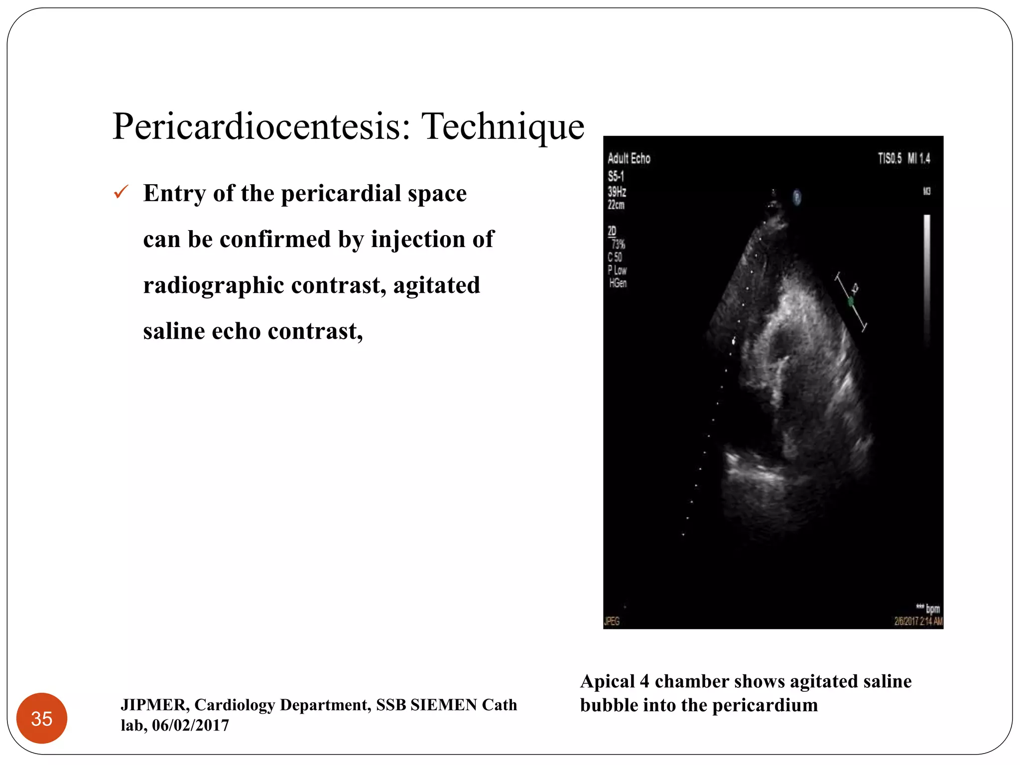 Pericardiocentesis | PPTX