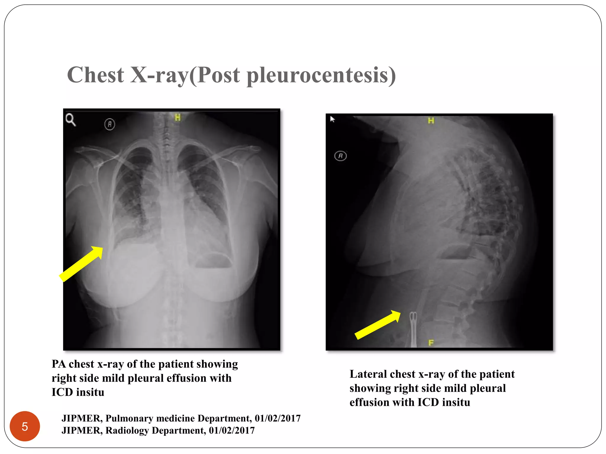 Pericardiocentesis | PPTX