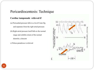 Pericardiocentesis | PPTX