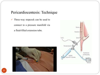 Pericardiocentesis Technique