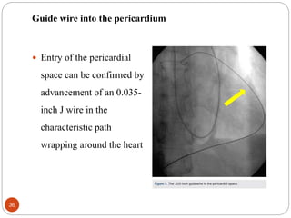 Pericardiocentesis Technique