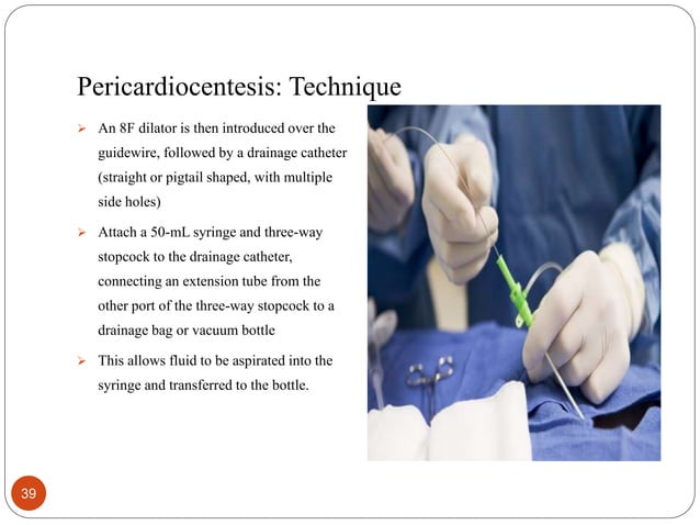 Pericardiocentesis