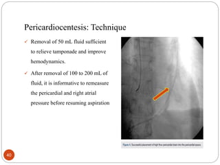 Pericardiocentesis Fluid