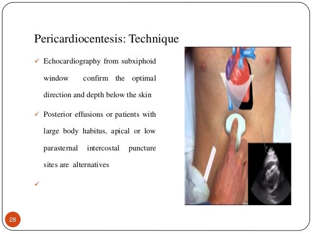 Pericardiocentesis