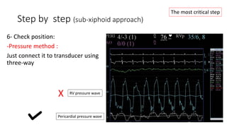 Pericardiocentesis | PDF
