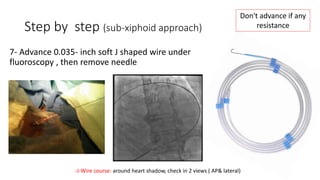 Pericardiocentesis | PDF