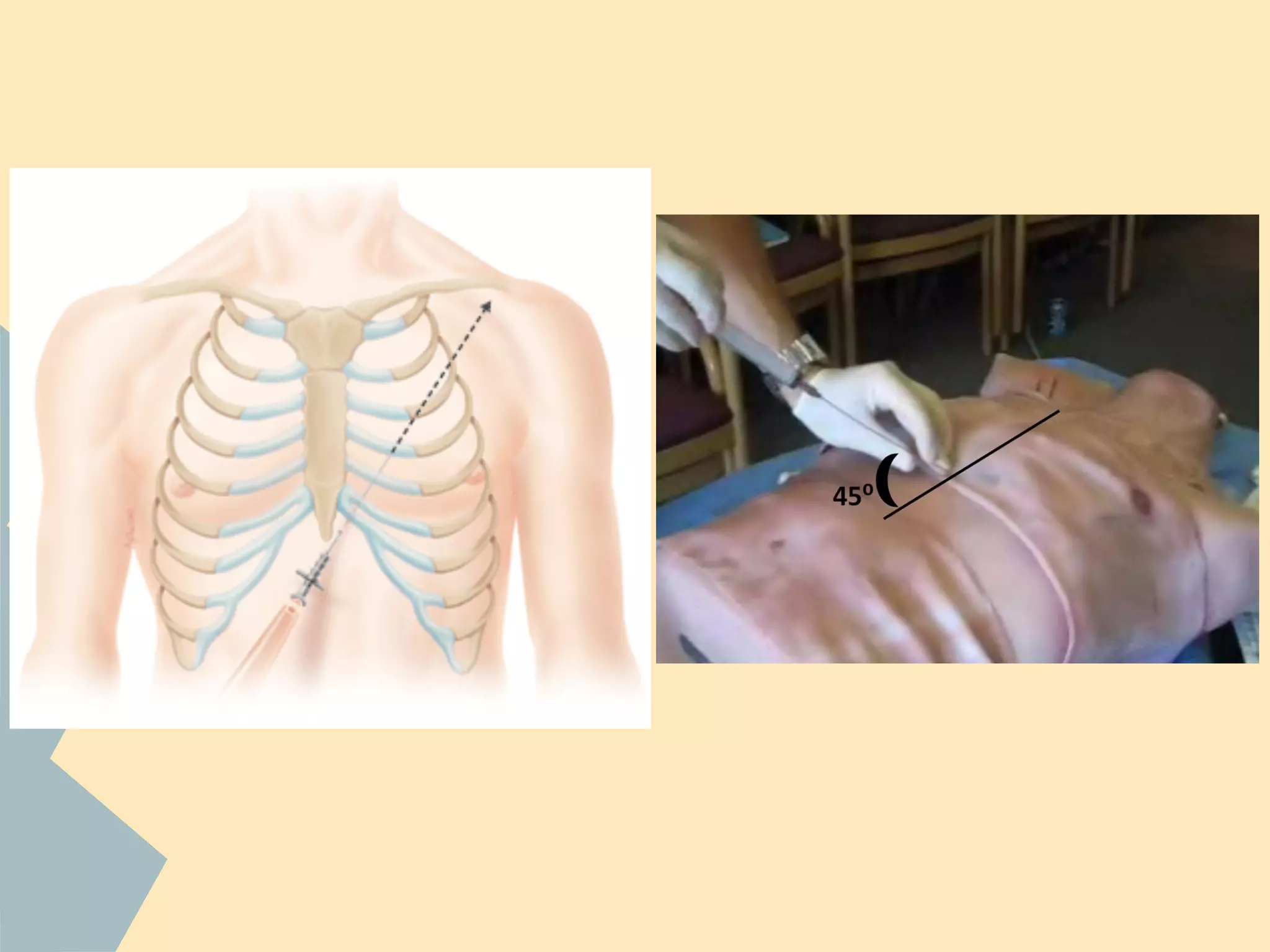 Pericardiocentesis | PDF