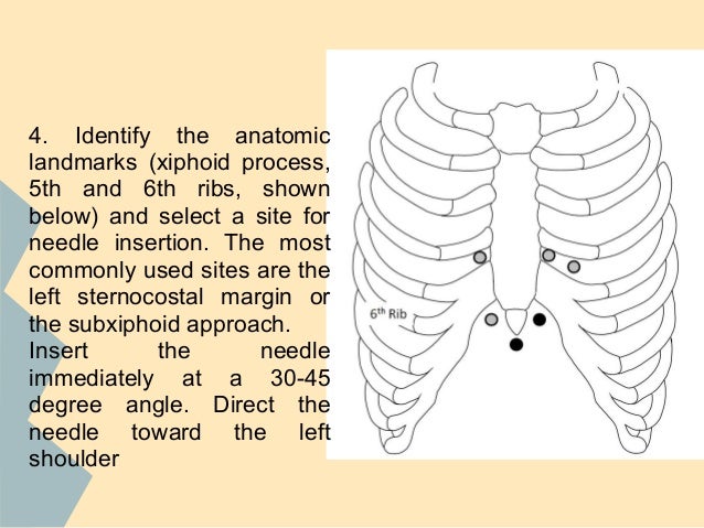 Pericardiocentesis