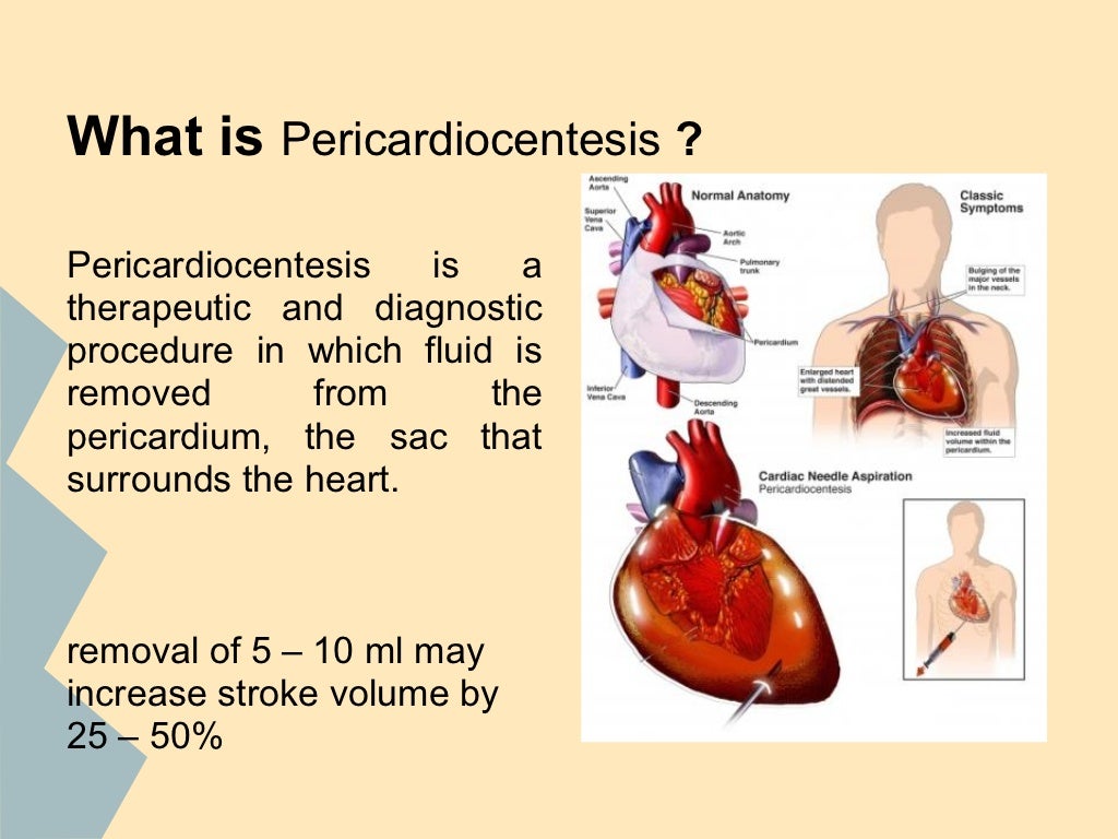 Pericardiocentesis