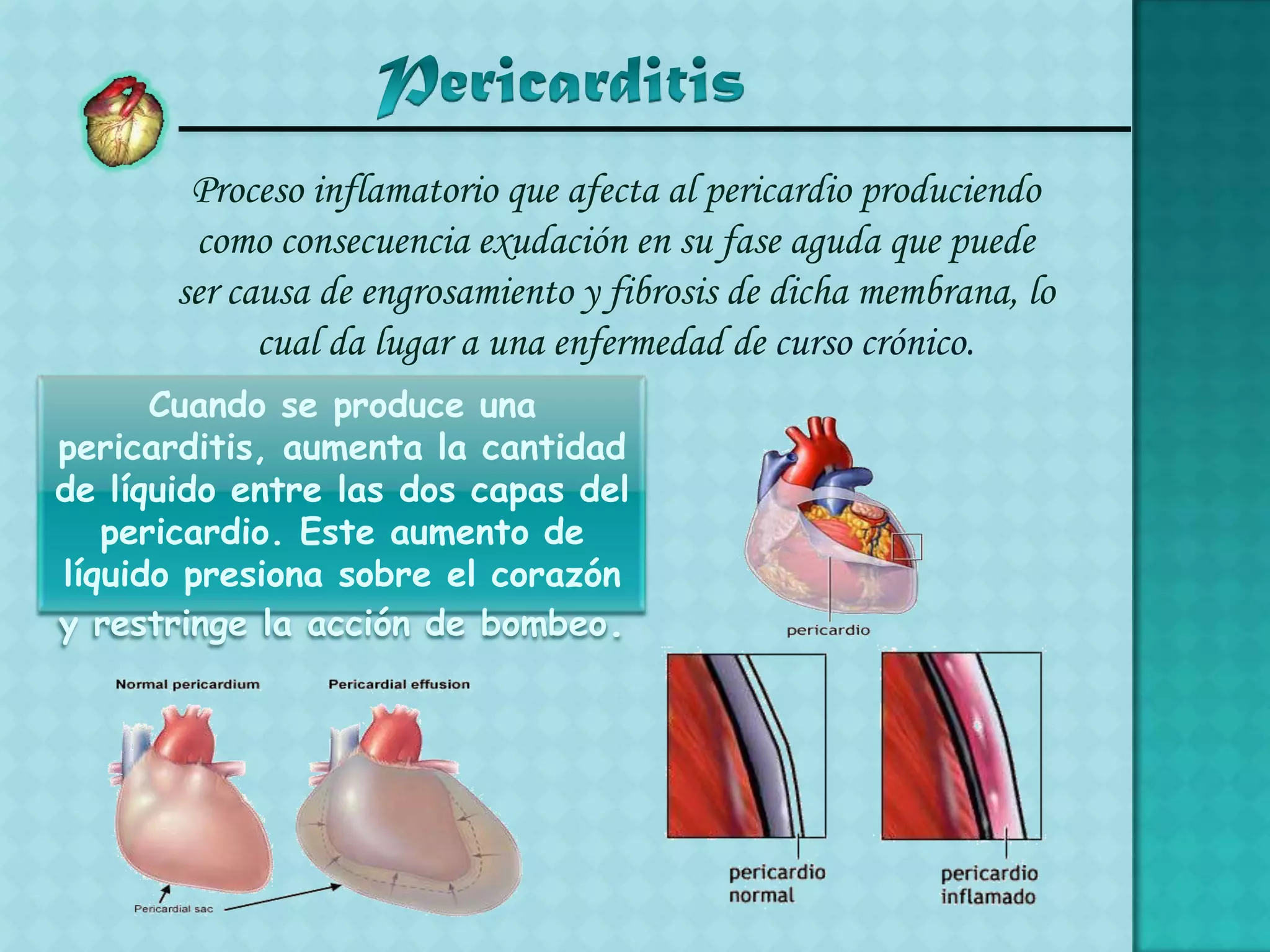 Pericarditis | PPTX