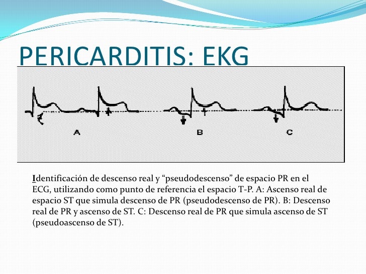 Pericarditis