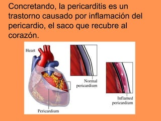Pericarditis | PPT