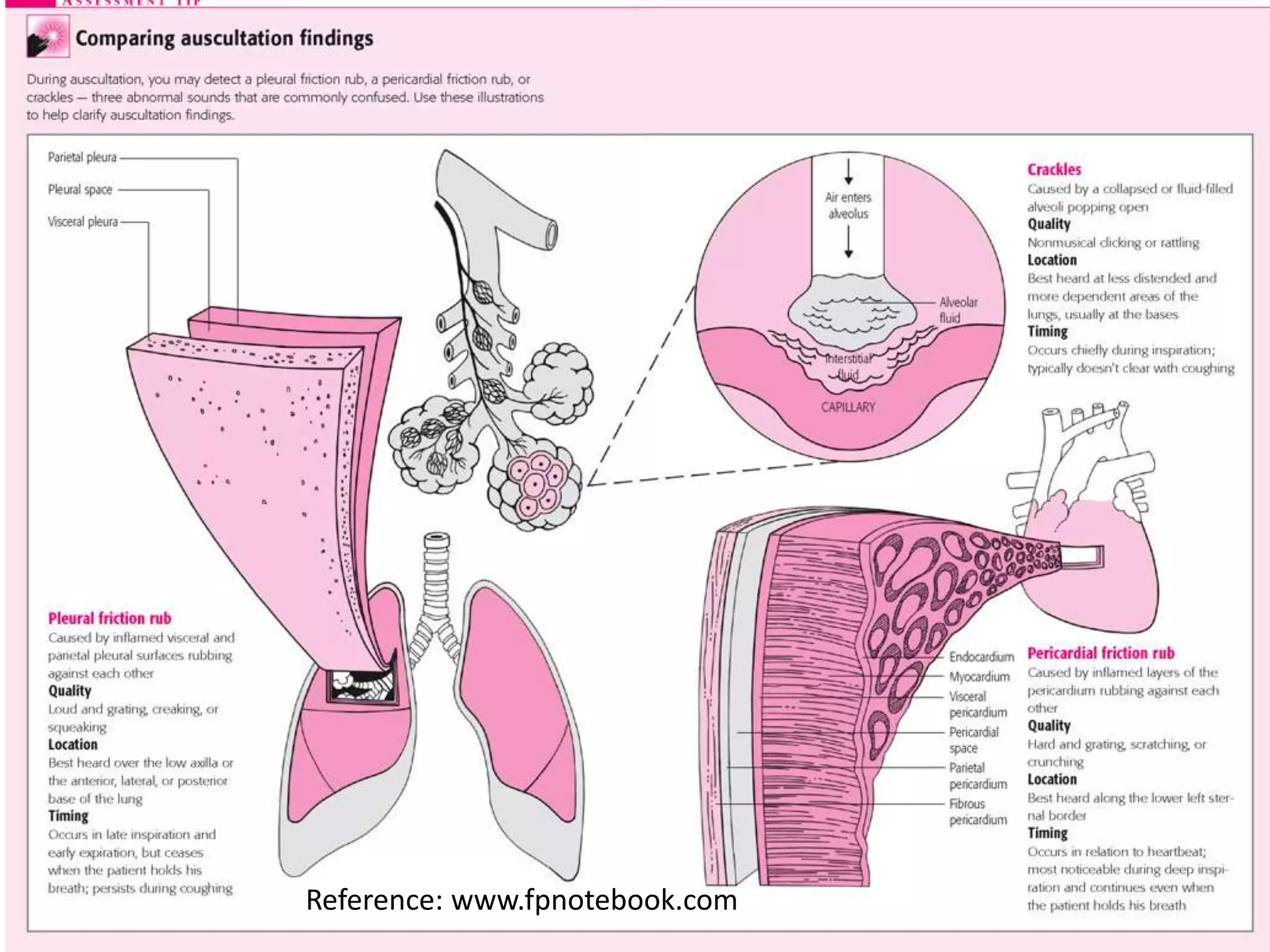 Pericarditis | PPTX