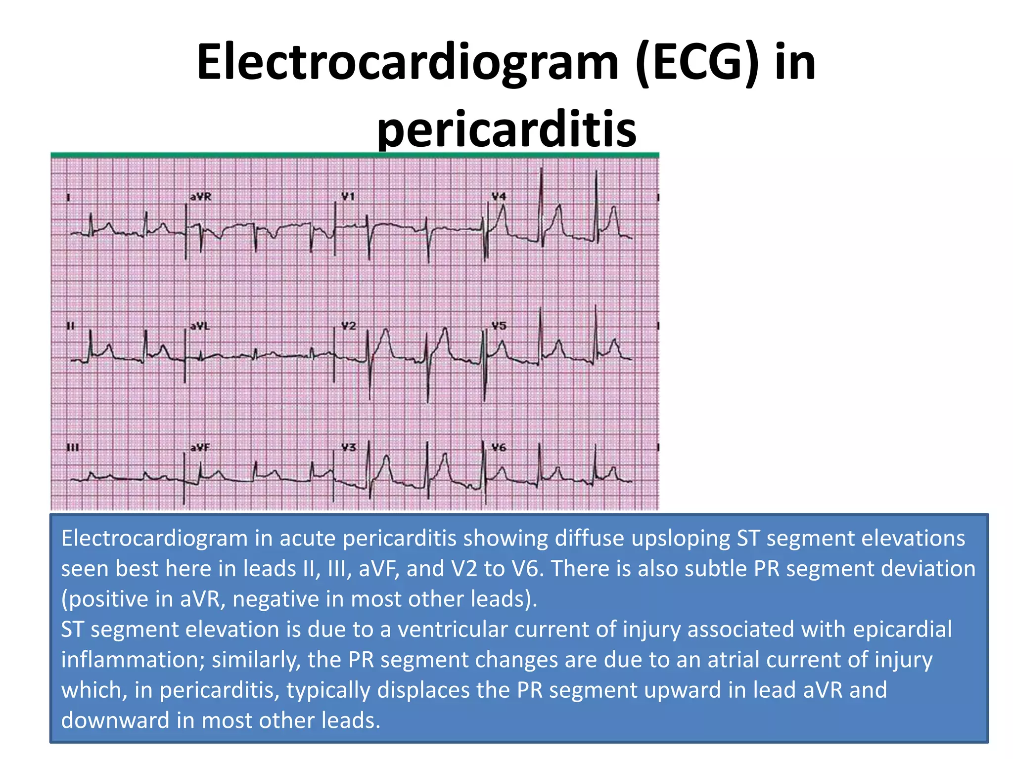 Pericarditis | PPTX