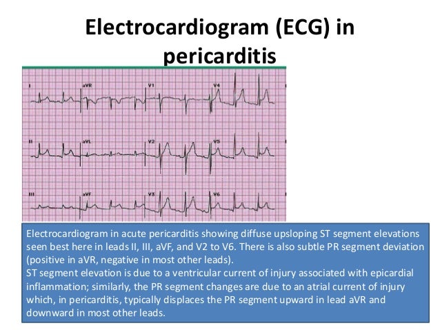 Pericarditis
