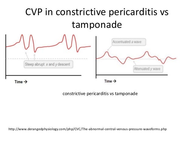 Pericarditis