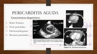Pericarditis | PPTX